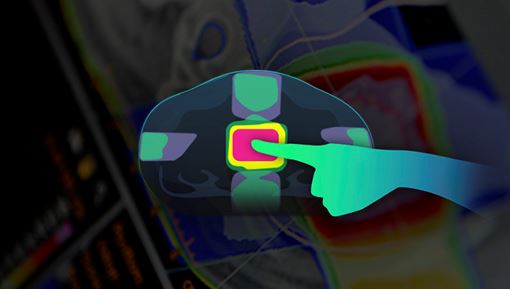 治疗计划系统 – RayStation | RaySearch Laboratories China