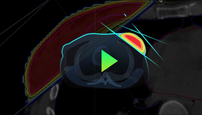 治疗计划系统 – RayStation | RaySearch Laboratories China